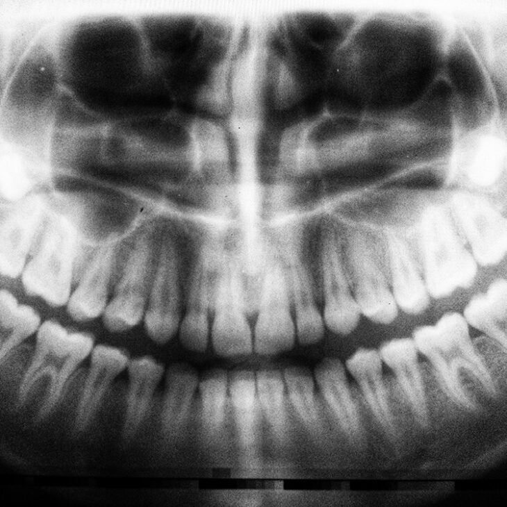 Dentoalveolar Surgery In London | Harley Street Maxillofacial Clinic